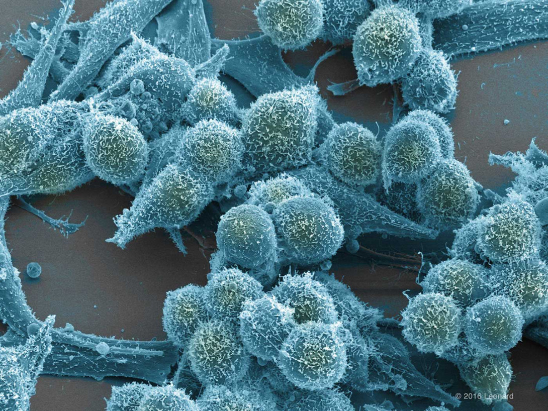 Melanoma Cells | Andrew Paul Leonard APL Microscopic